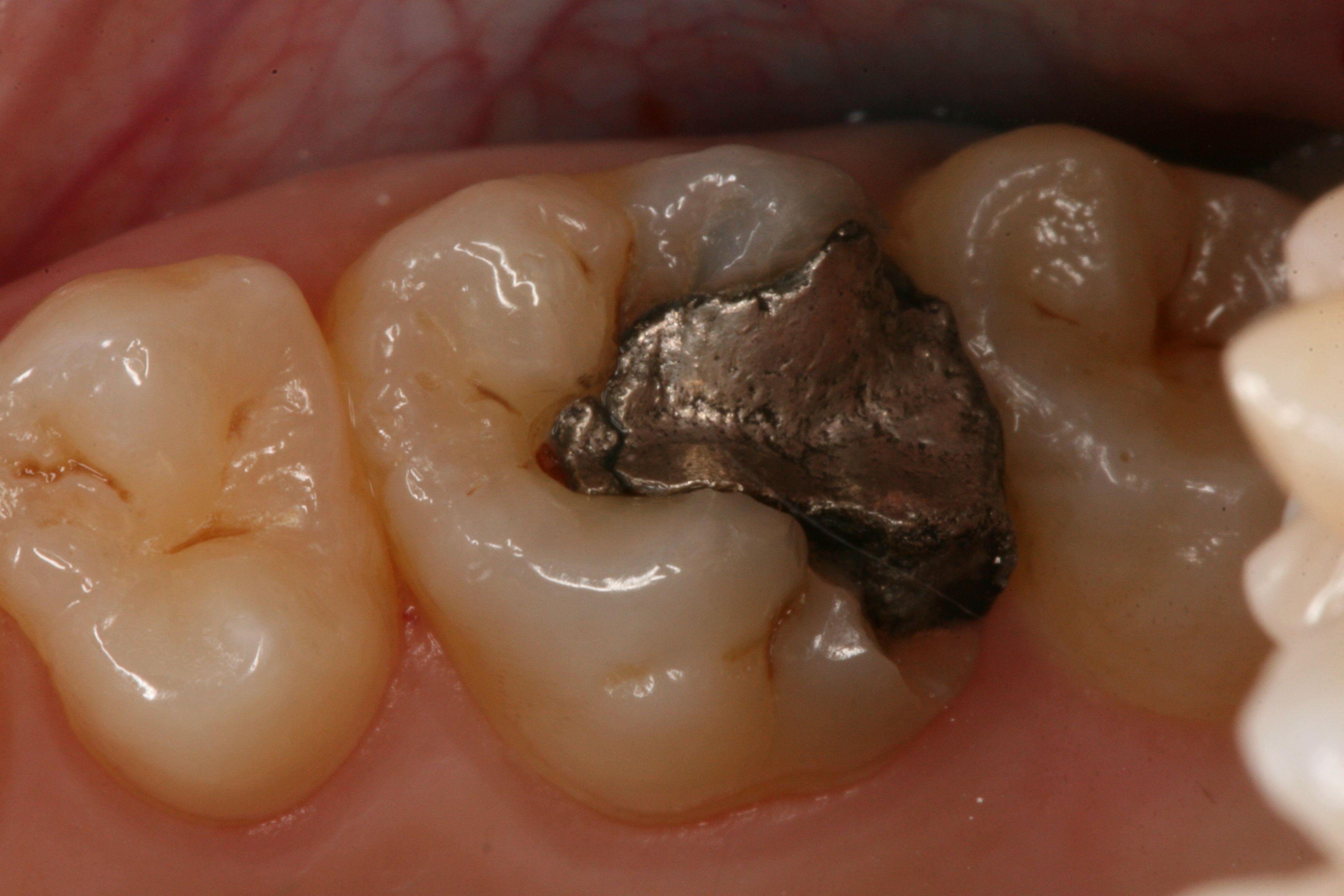 Inlay/Fractured tooth - Inlays / Onlays - Before and After Gallery