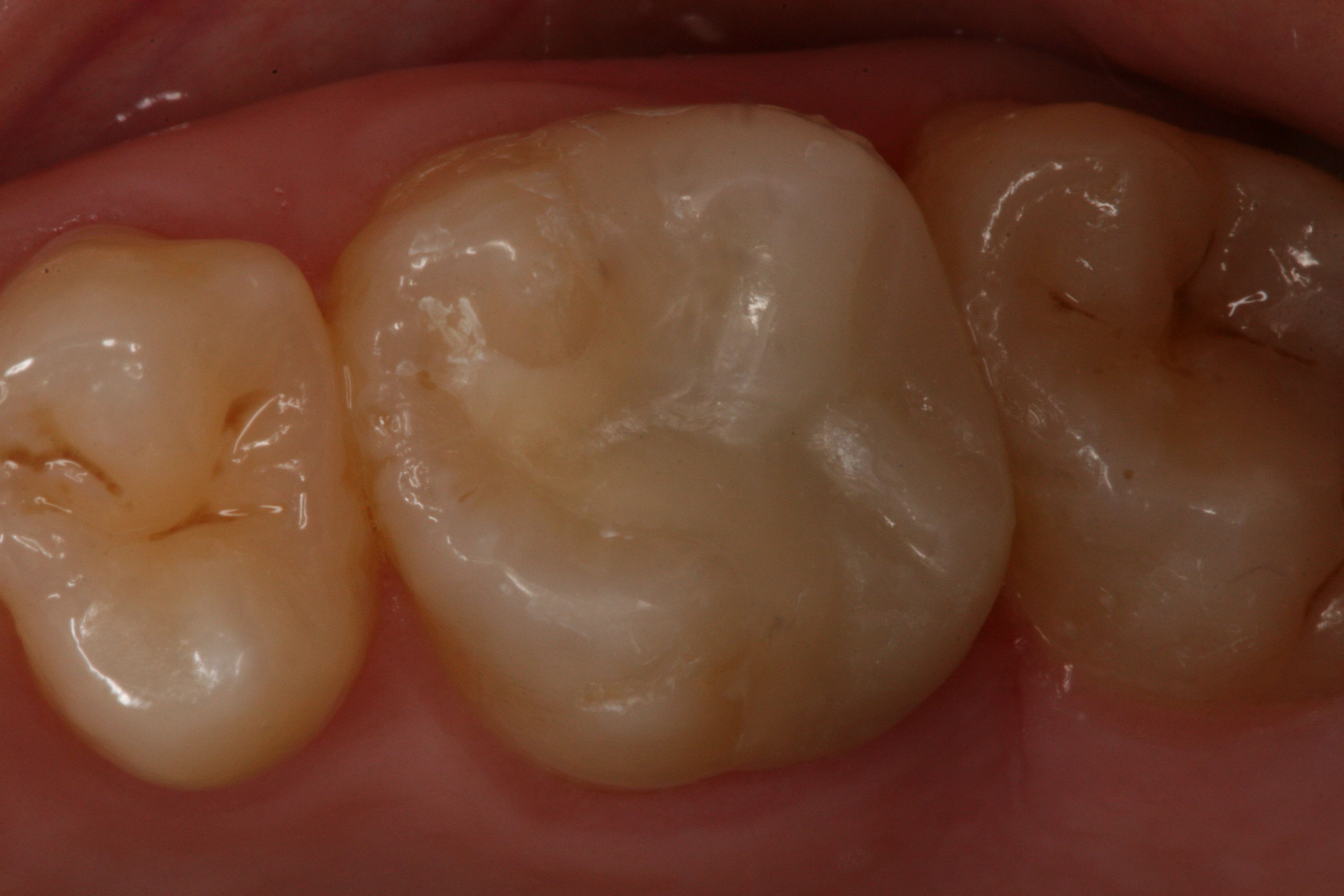 Inlay/Fractured tooth - Inlays / Onlays - Before and After Gallery