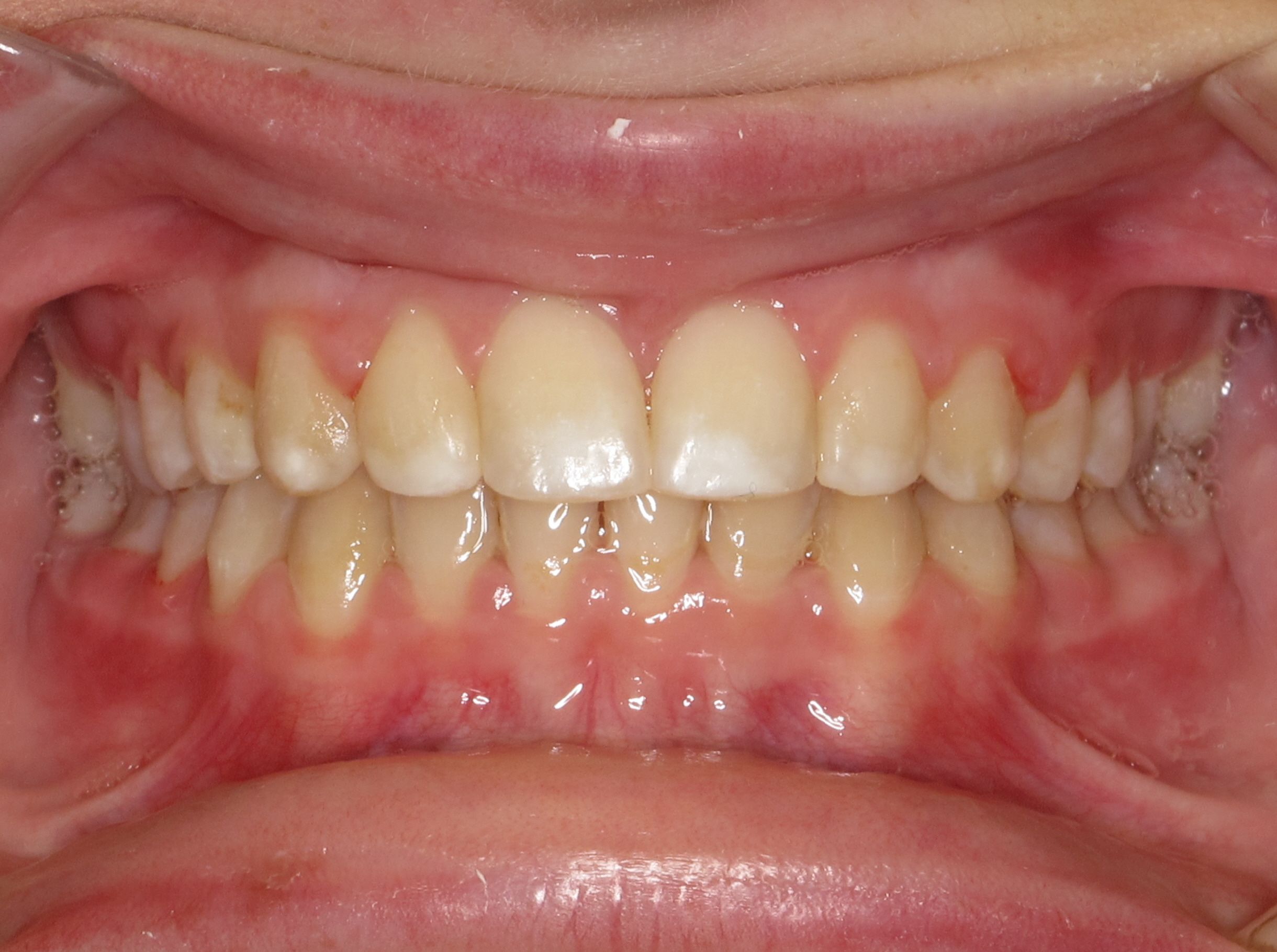 Narrow Arch with Anterior Cross Bite - Narrow Arch/Narrow Smile ...