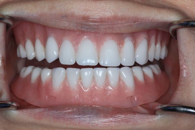 Implant Dentures Patient Photo - Scottsdale, AZ - Hybrid Implant ...