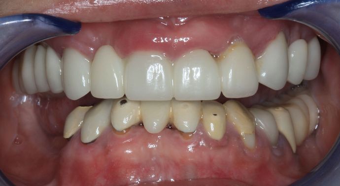 Implant Dentures Patient Photo - Scottsdale, AZ - Hybrid Implant ...
