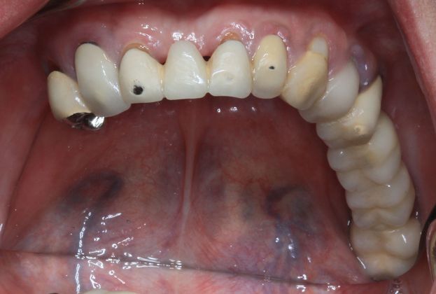 Implant Dentures Patient Photo - Scottsdale, AZ - Hybrid Implant ...