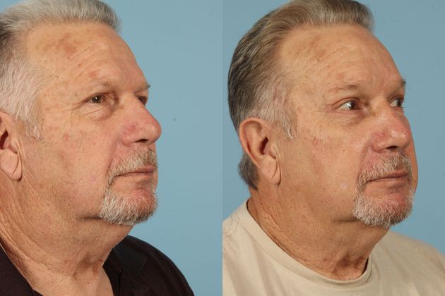 Roland - Eyelid Surgery - Before and After Gallery