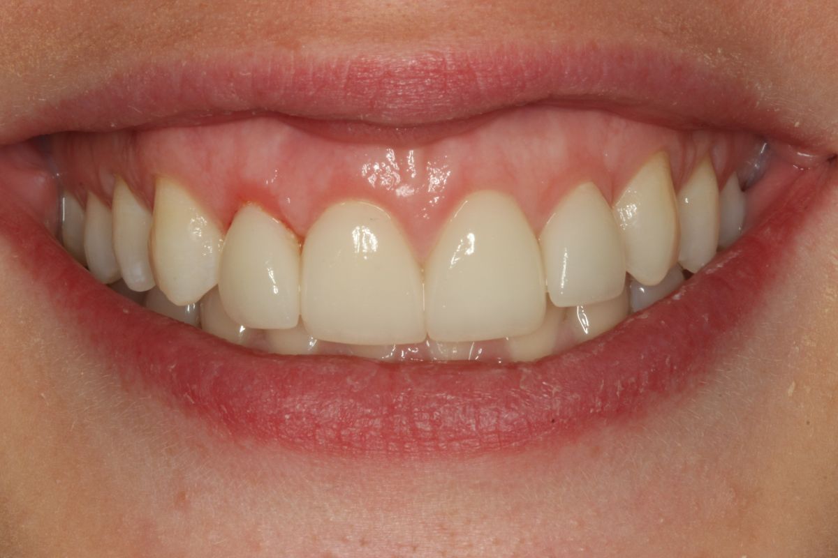 Case 1 Wichita Ks Laser Gum Reshaping Before And After Gallery