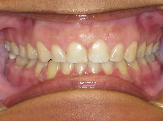 Space And Cross Bite Tooth Spacing Before And After Gallery space-and-cross-bite-tooth-spacing-before-and-after-gallery