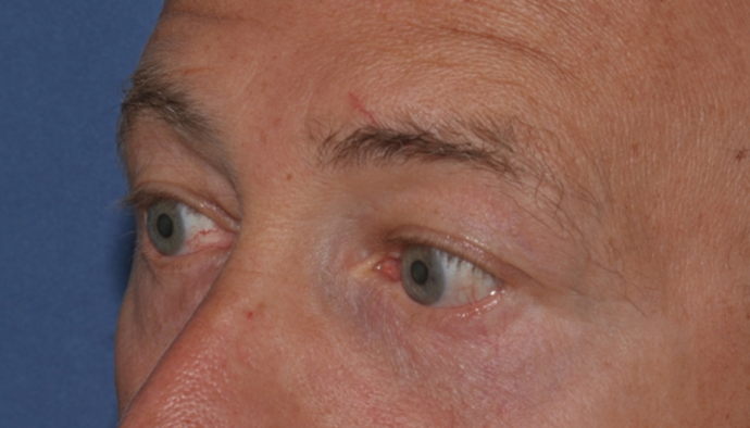 Fat Transposition Lower Eyelid Surgery For Tear Trough Deformity