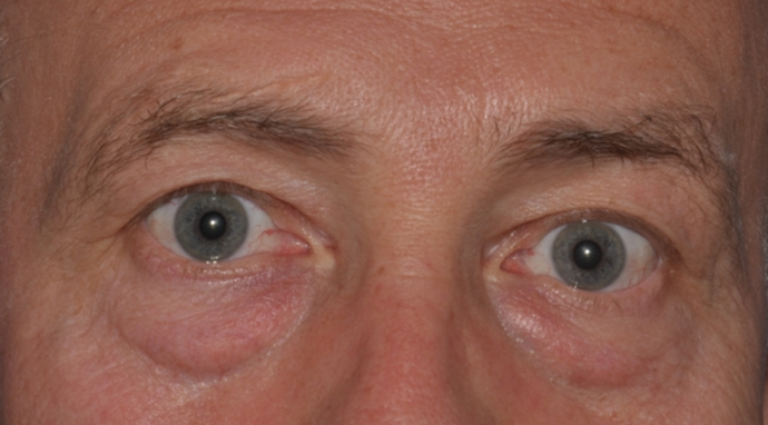 Fat Transposition Lower Eyelid Surgery For Tear Trough Deformity