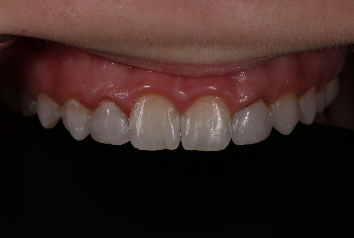 Peg Laterals Bonding - Dental Bonding - Teeth Bonding - Before and ...