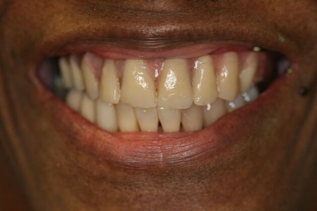 Implant supported Fixed Hybrid Overdenture