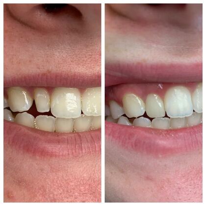 Case 14 - Veneers / Smile Makeover - Before and After Gallery