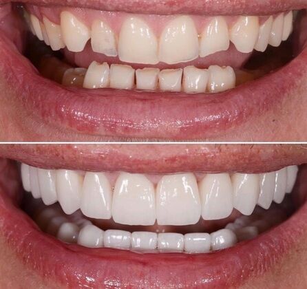 Case 16 - Veneers / Smile Makeover - Before and After Gallery