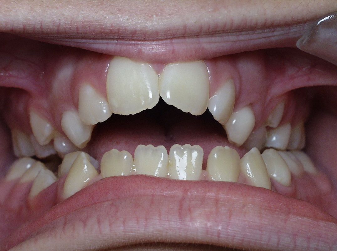 Open Bite and Narrow Arch - Open bite - Before and After Gallery