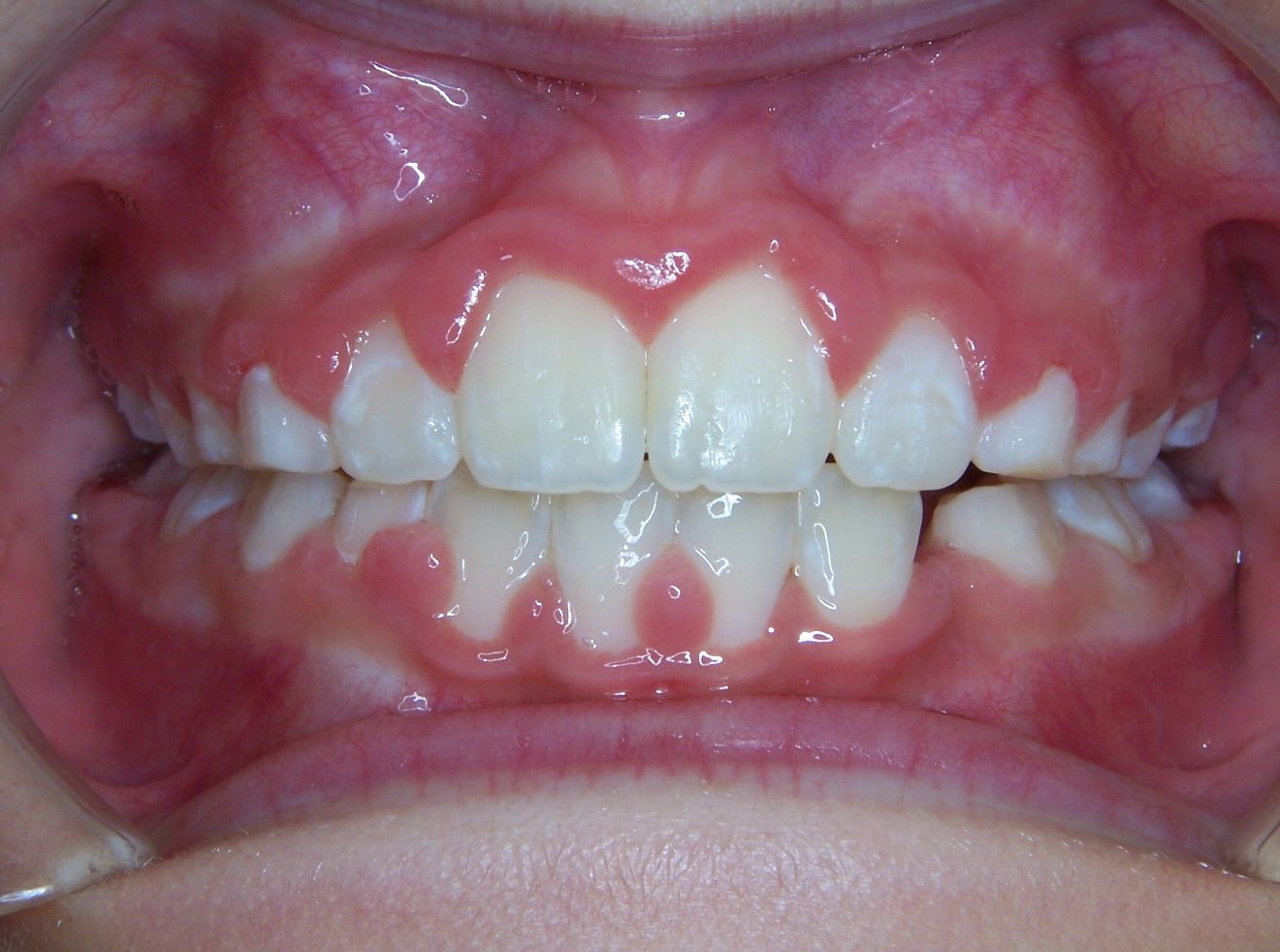 Open Bite and Very Narrow Arch - Children Smiles - Before and After Gallery