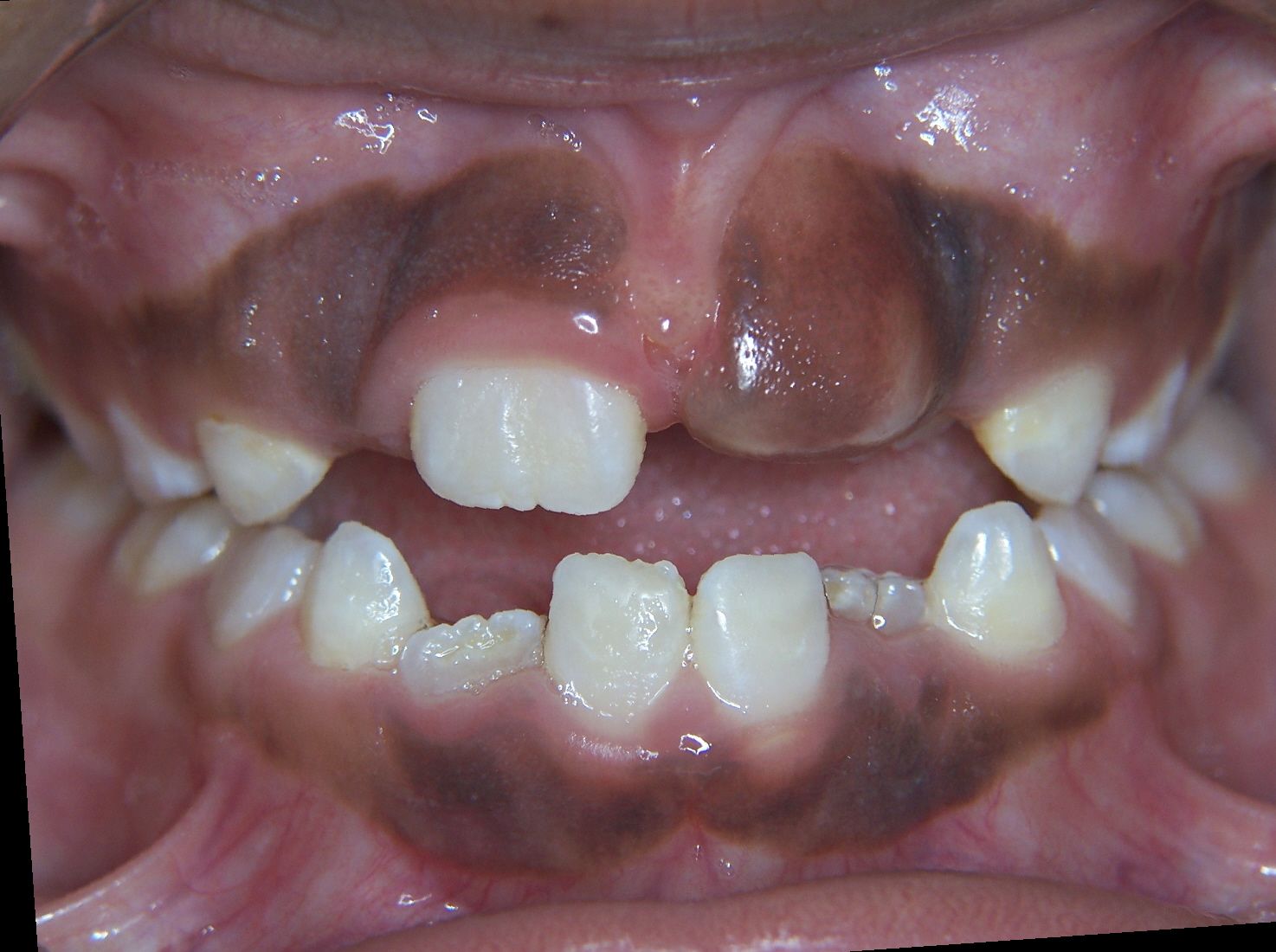 Open Bite - Children Smiles - Before and After Gallery