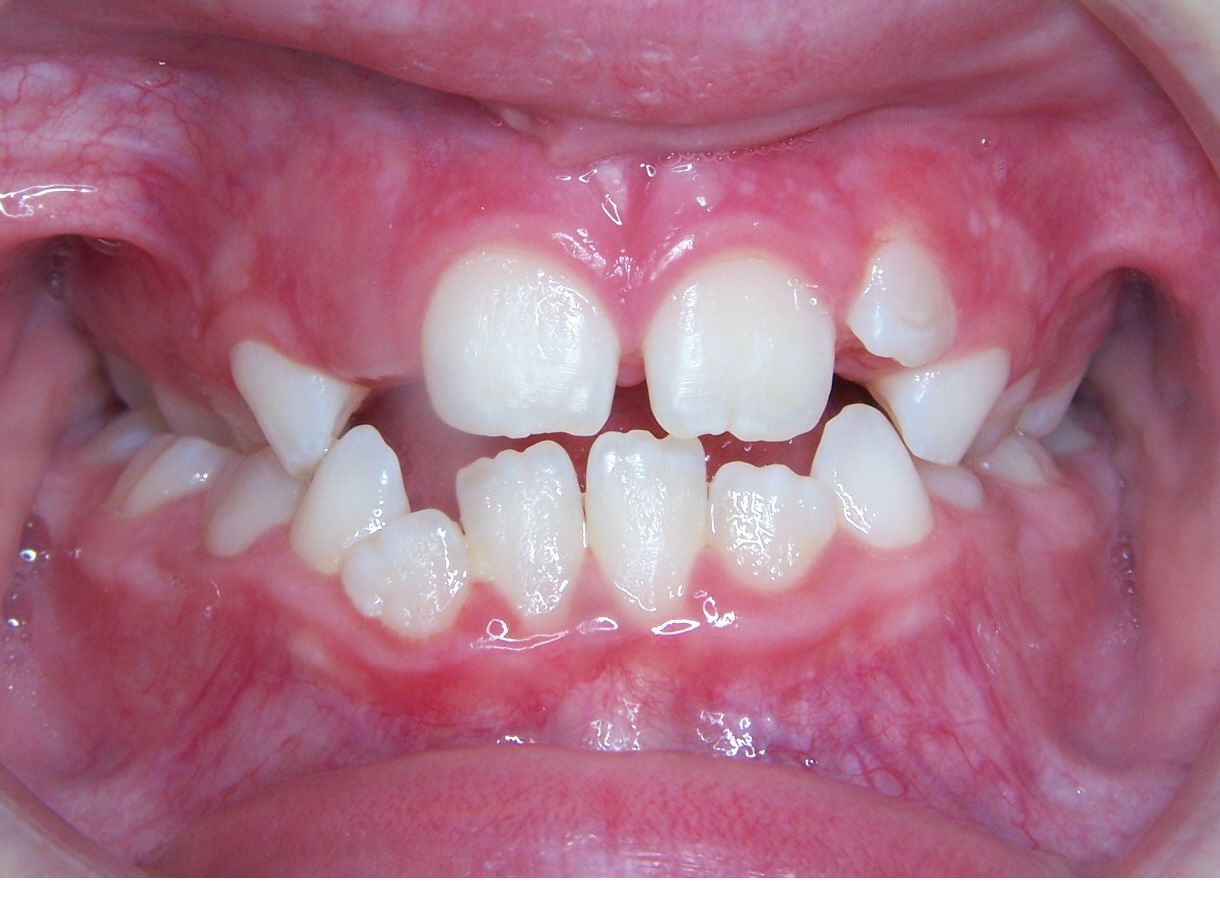 Open Bite and Crowding - Children Smiles - Before and After Gallery