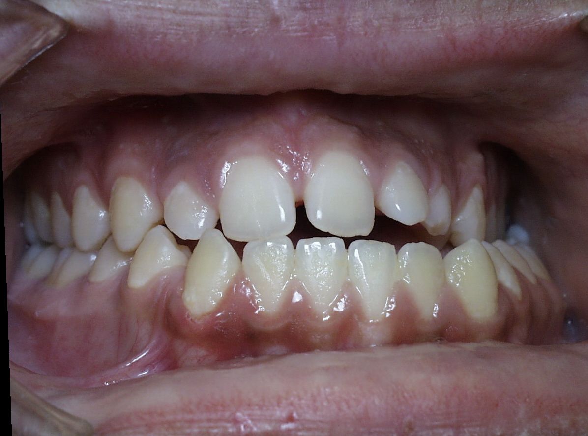 Open Bite - Orthognathic Surgery/Jaw Surgery - Before and After Gallery