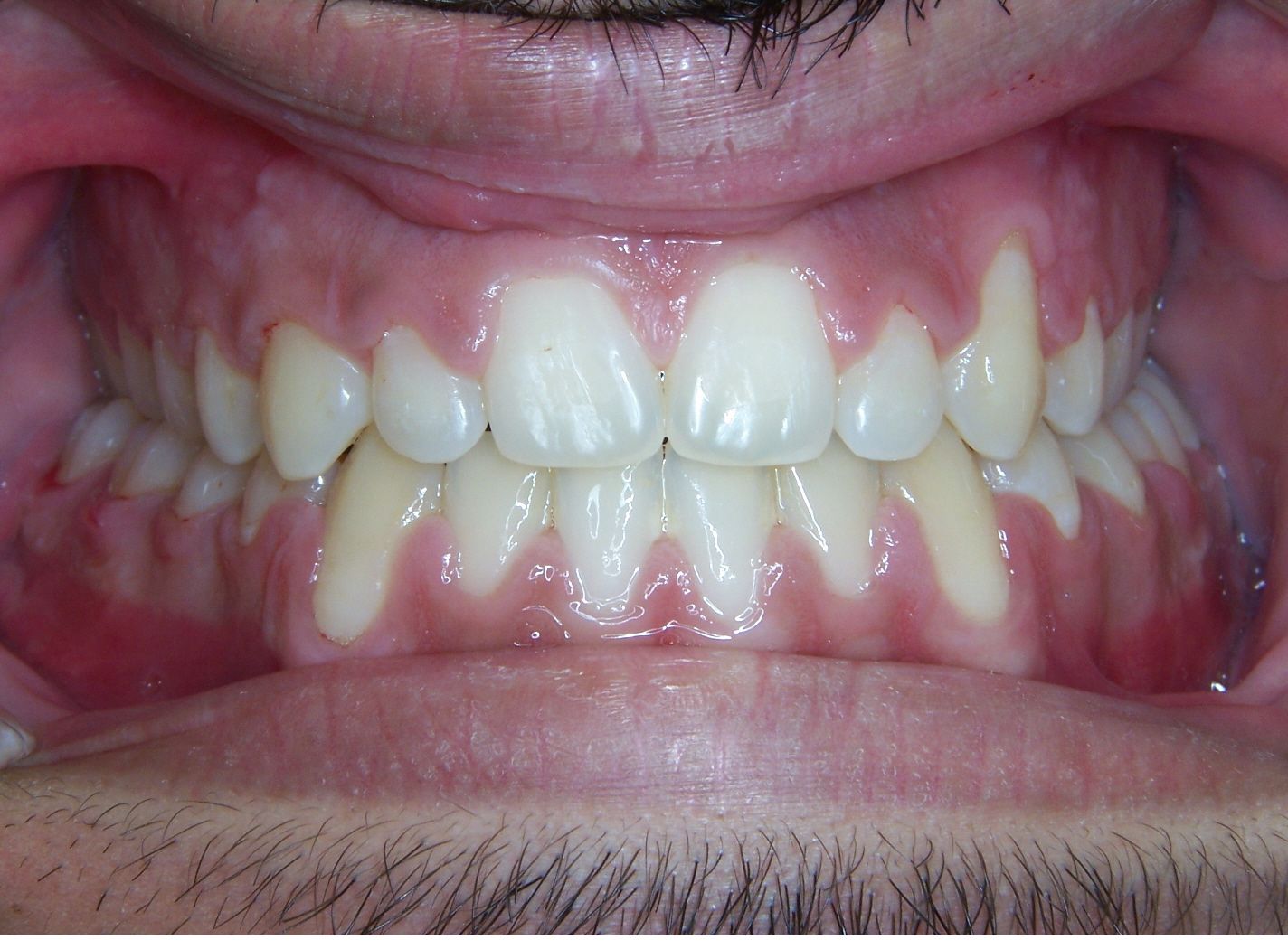 Open Bite - Orthognathic Surgery/Jaw Surgery - Before and After Gallery