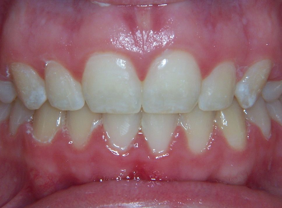 Narrow Arch - Narrow Arch/Narrow Smile - Before and After Gallery