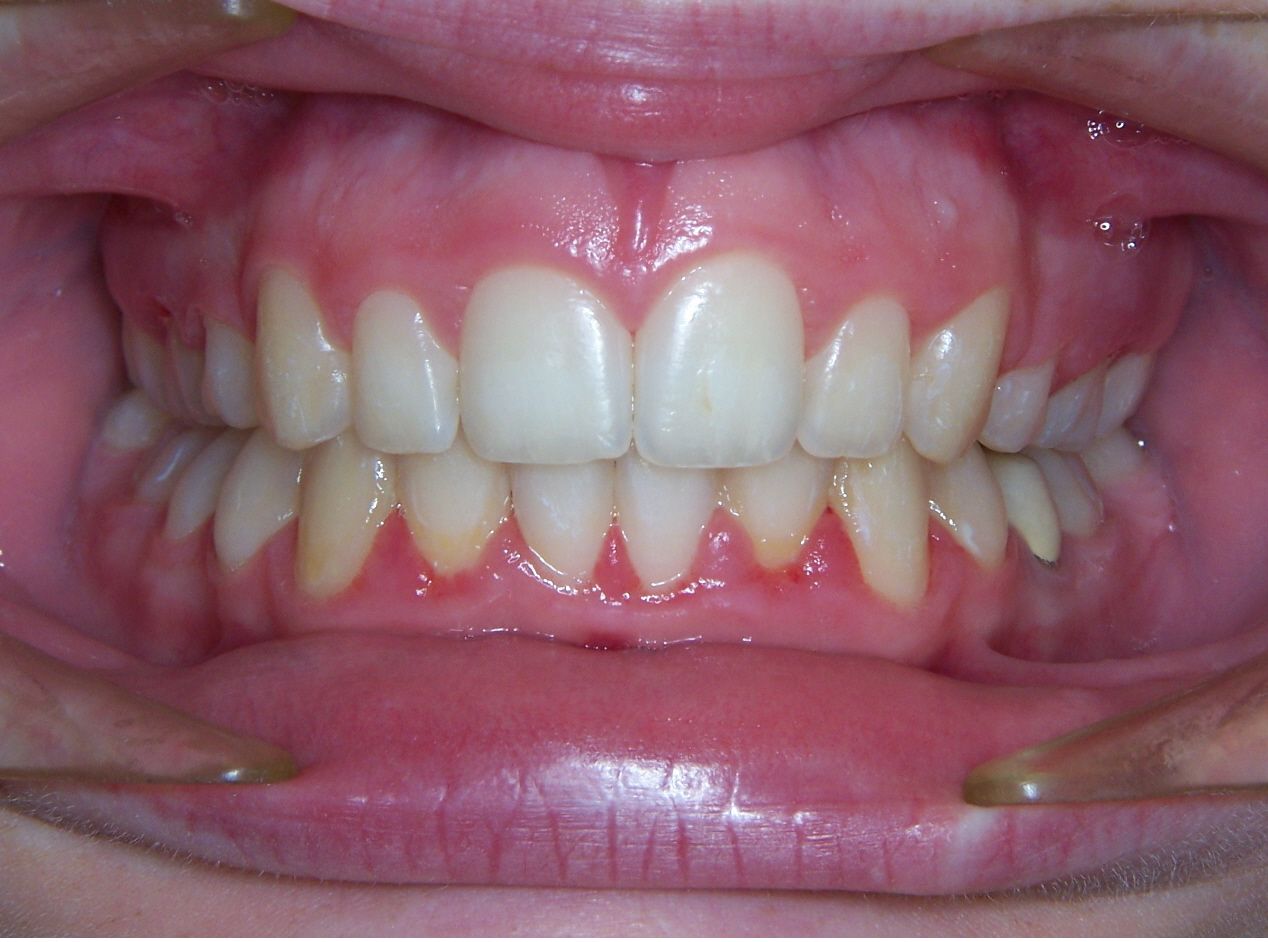 Over Bite and Narrow Arch - Narrow Arch/Narrow Smile - Before and After ...