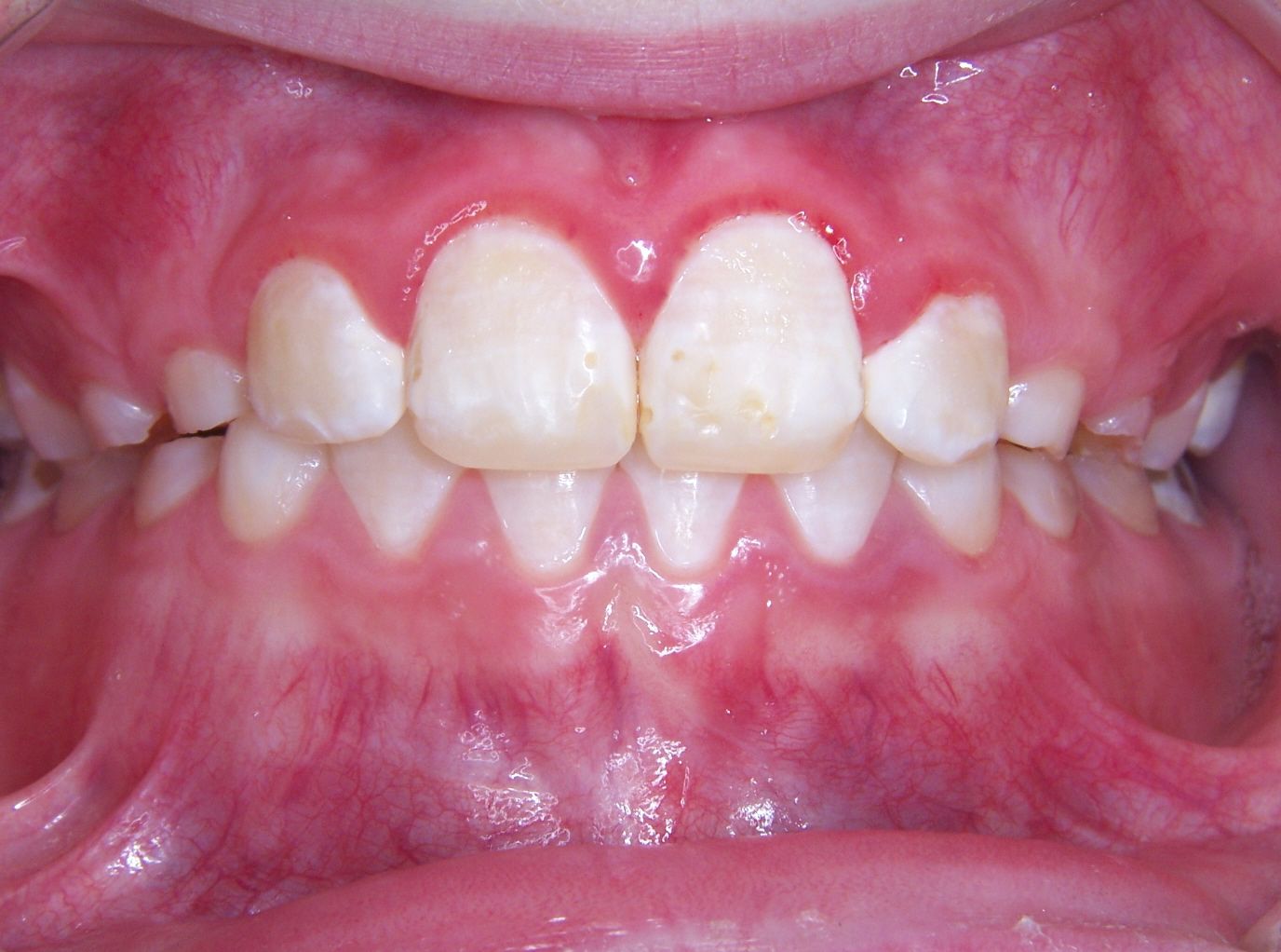 Under Bite - Children Smiles - Before and After Gallery