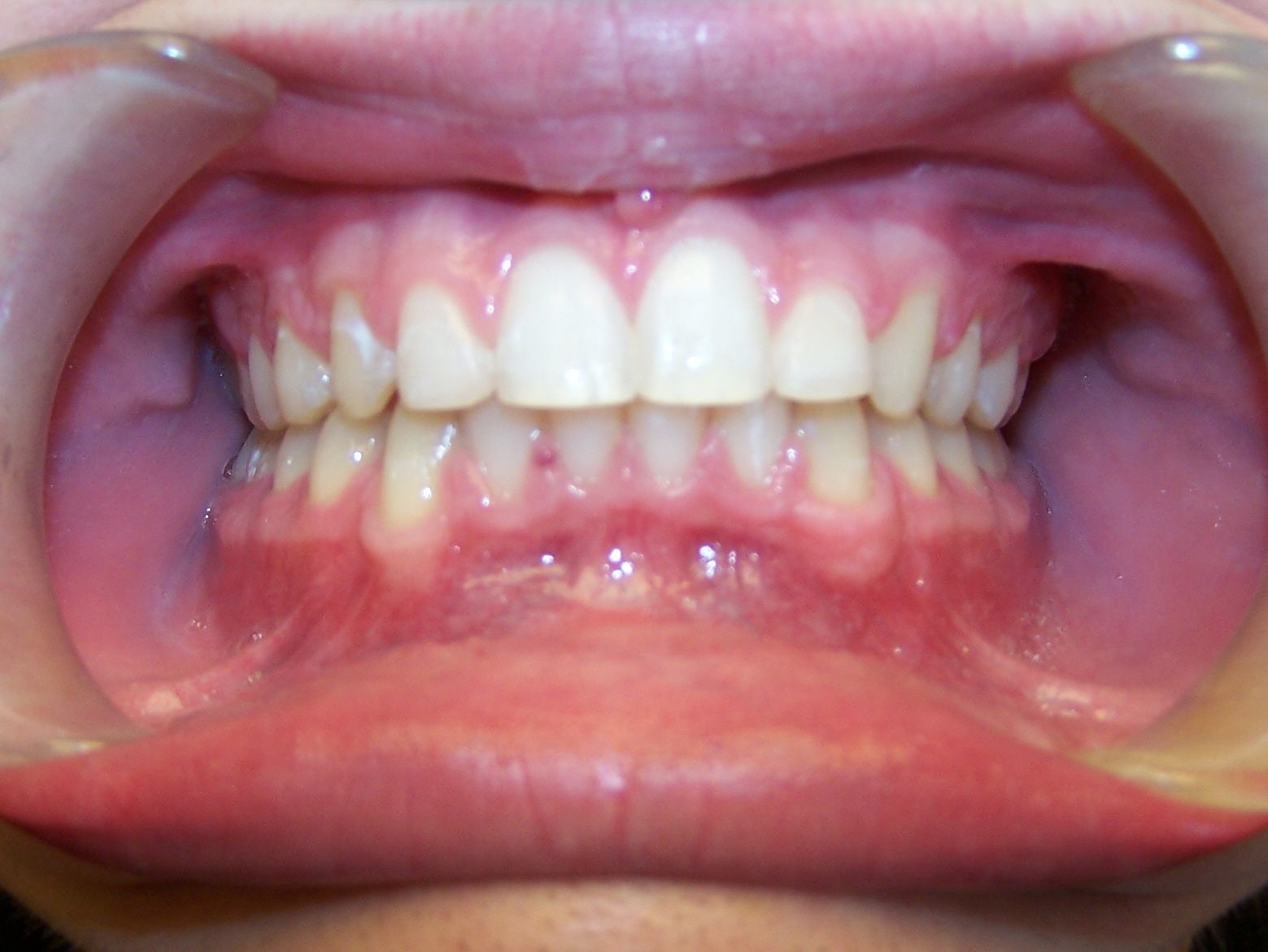 Great Smile - Deep Bite/Overlapping Teeth - Before and After Gallery