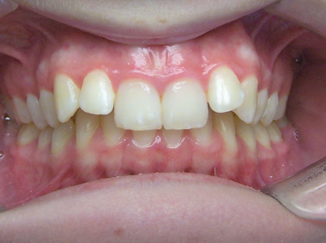 Philadelphia and Suberbs Great Smiles - Deep Bite/Overlapping Teeth ...